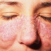 Lupus - English Dermatology