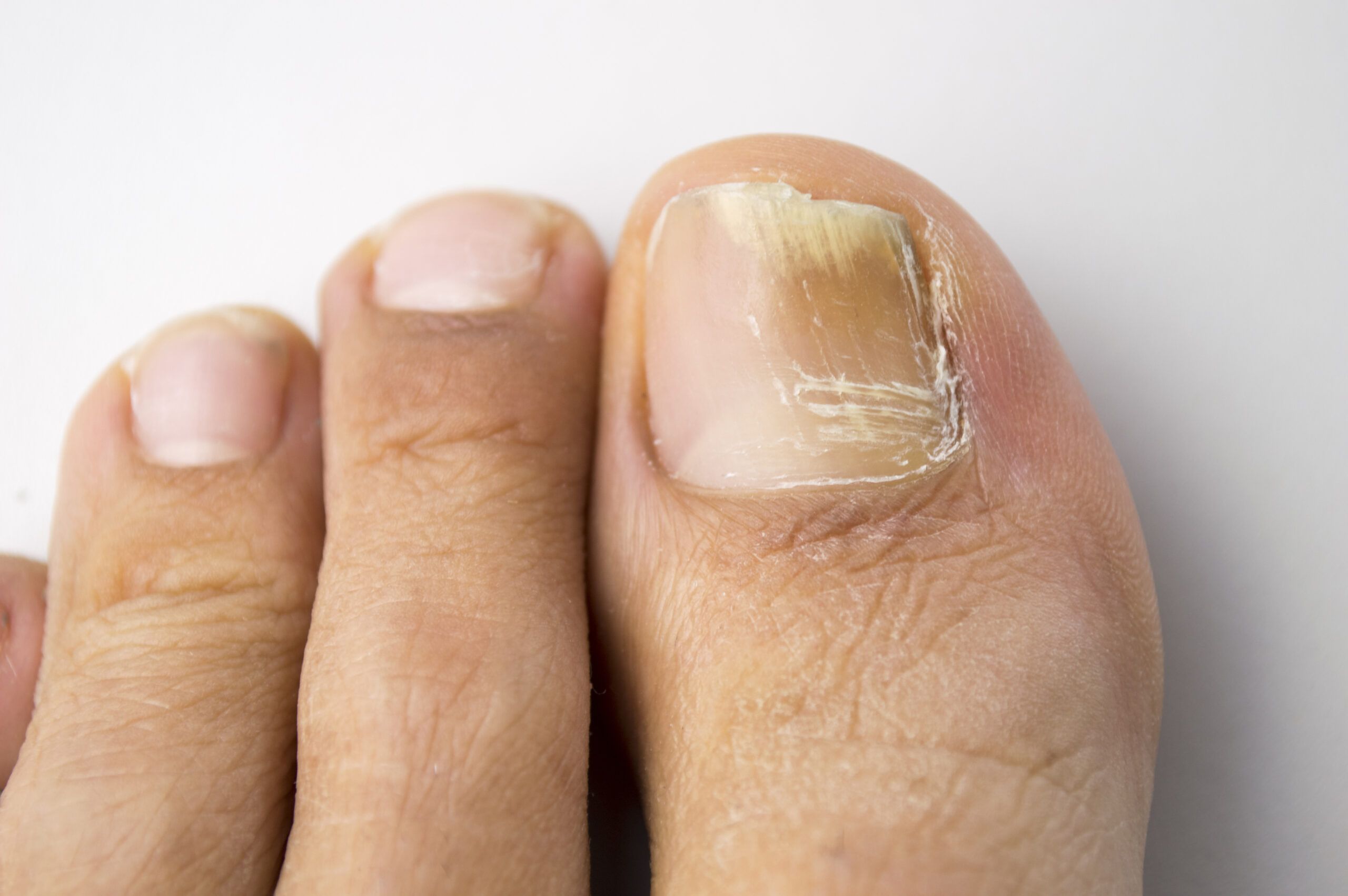 Nail Disorders - English Dermatology