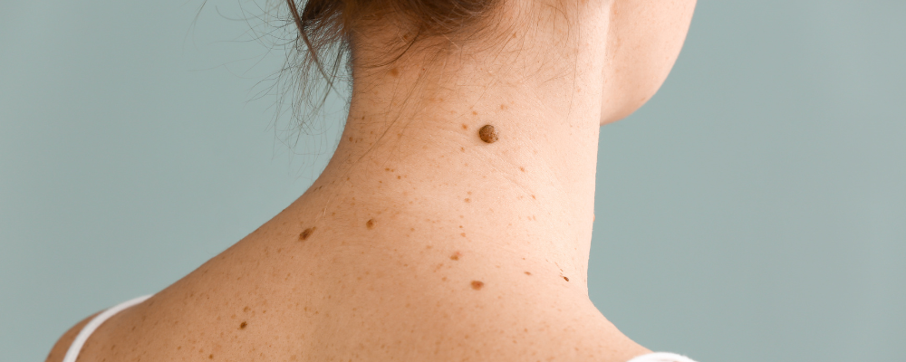 Skin Cancer Basics: Know Your ABCDEs - English Dermatology