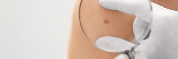 The Importance of Starting the Year with a Skin Check - English Dermatology